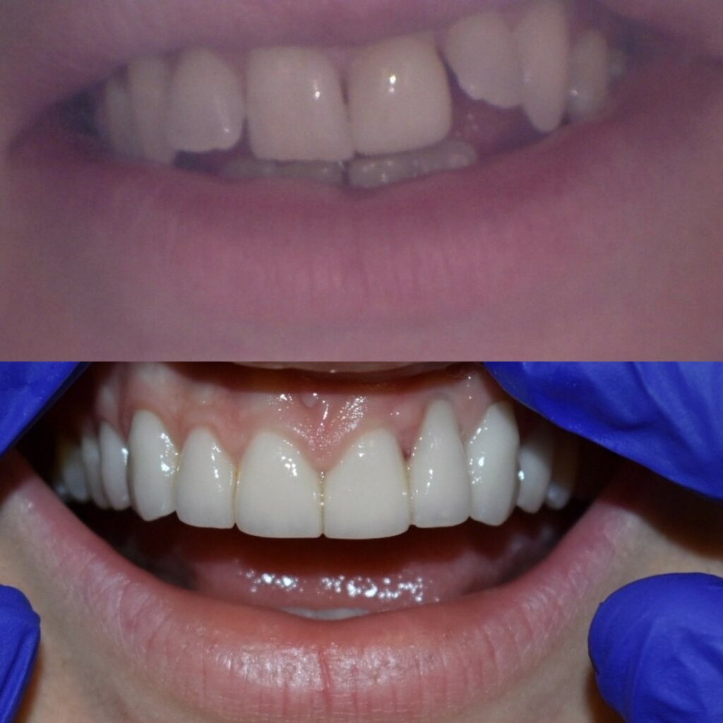 Before and After Veneers Procedure | Dr. Christian Chung, D.D.S. Before and After Veneers Procedure | Dr. Christian Chung, D.D.S.