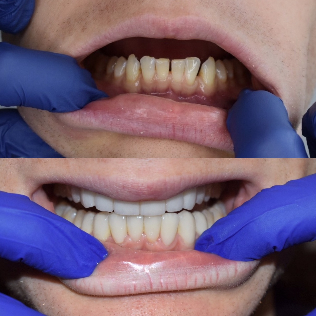 Before and After Veneers Procedure | Dr. Christian Chung, D.D.S. Before and After Veneers Procedure | Dr. Christian Chung, D.D.S.