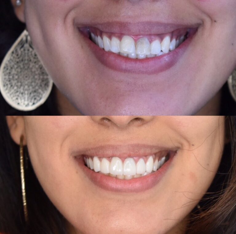 Before and After Veneers Procedure | Dr. Christian Chung, D.D.S. Before and After Veneers Procedure | Dr. Christian Chung, D.D.S.